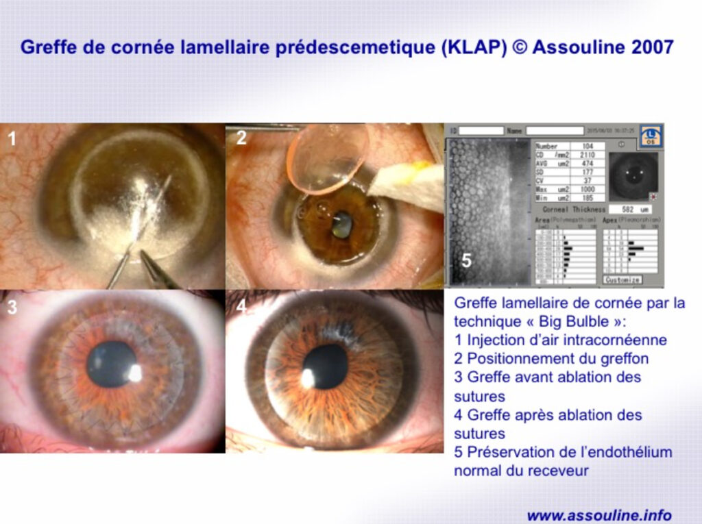 Greffe de cornée : traitements chirurgicaux du kératocone