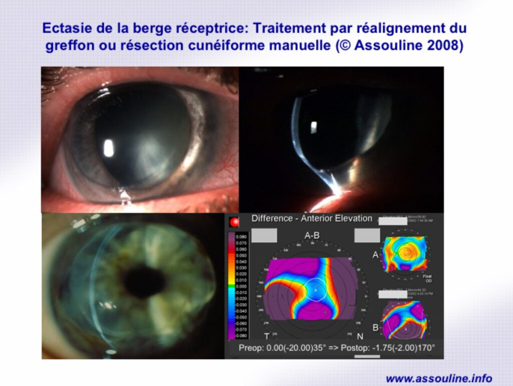 Greffe de cornée : traitements chirurgicaux du kératocone